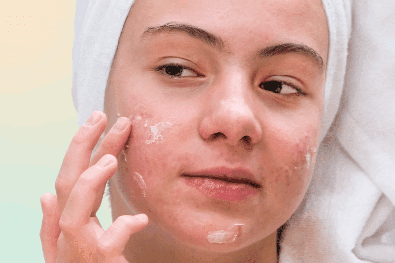 Skin Streaming for Acne: A New and Affordable Skincare Trend – Acne Club