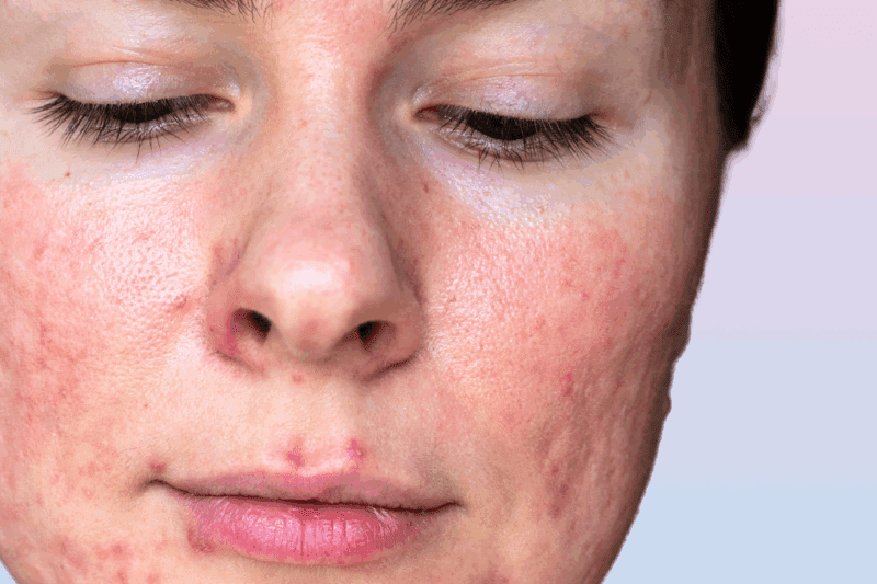 Rosacea vs. Acne: Rosacea Pustules Explained – Acne Club