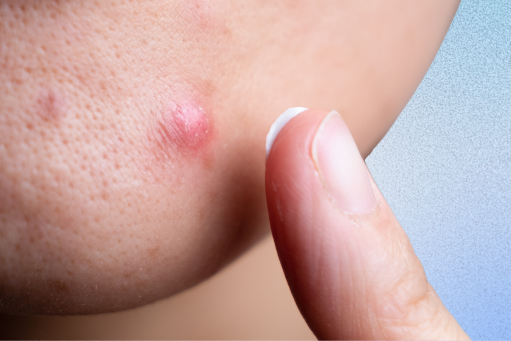 Accutane How It Works Side Effects And How To Get It Acne Club Accutane How It Works Side Effects And How To Get It Acne Club